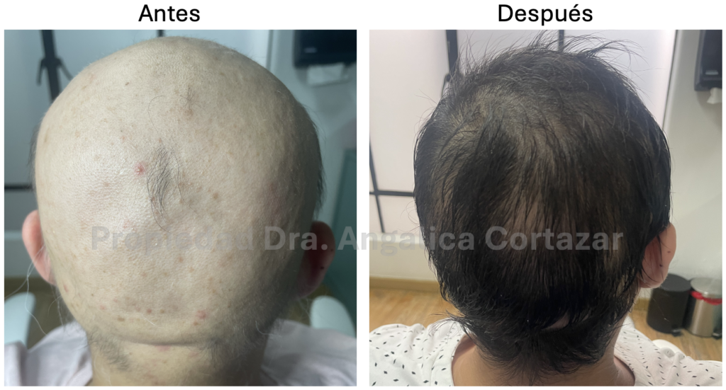 Enfrentando la Alopecia Areata: El antes y después de mi paciente ...